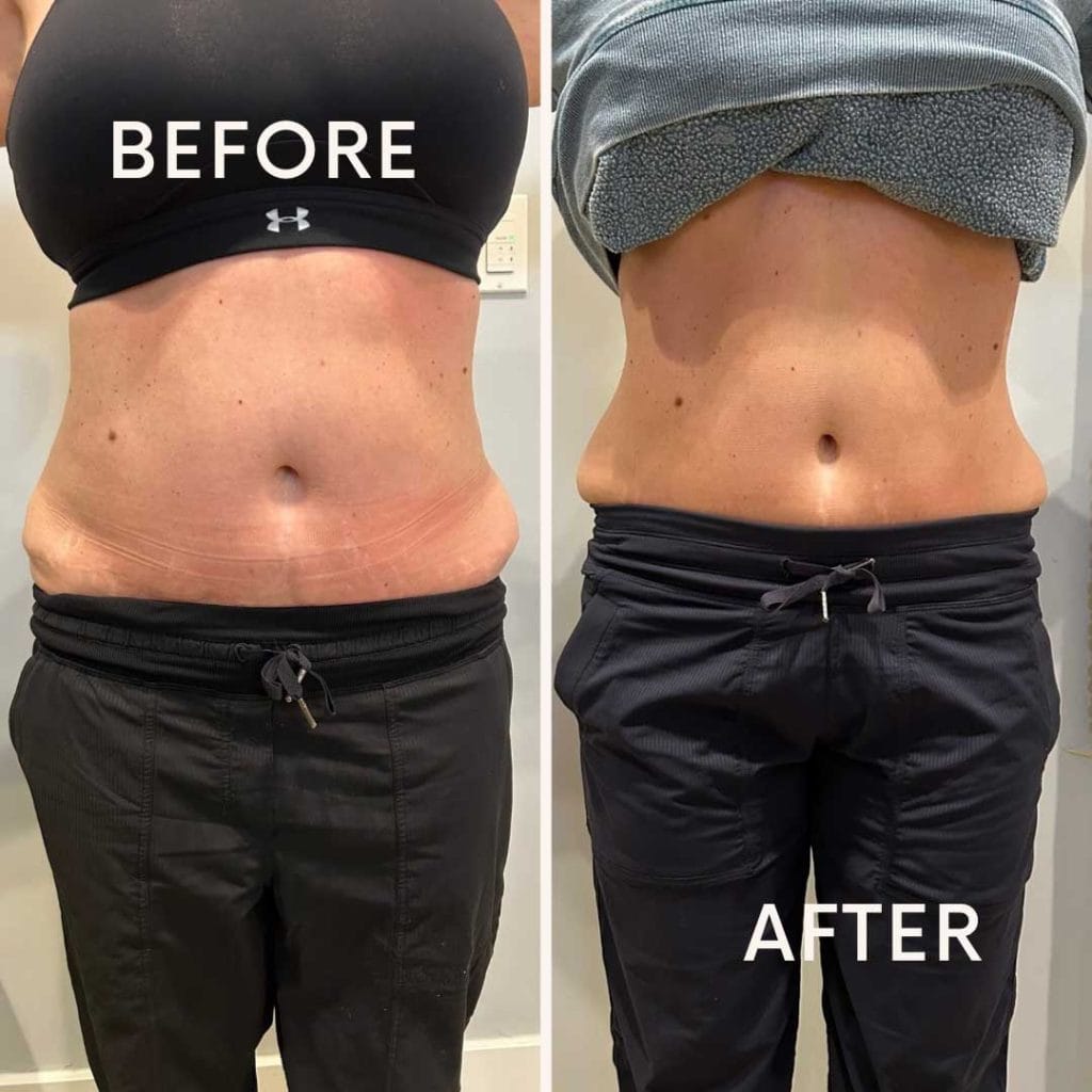Before & After – Body Bar – Chico, CA
